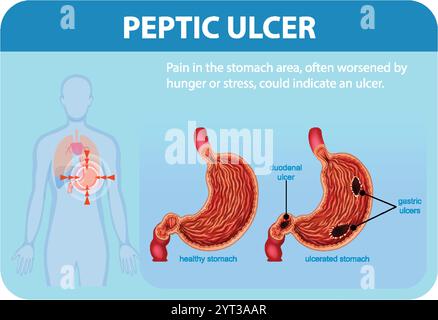Illustration of peptic ulcer symptoms and affected areas Stock Vector ...