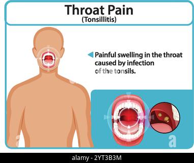 Illustration of tonsillitis symptoms and throat anatomy Stock Vector ...
