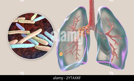 Primary lung tuberculosis with the Ranke complex. Computer illustration ...