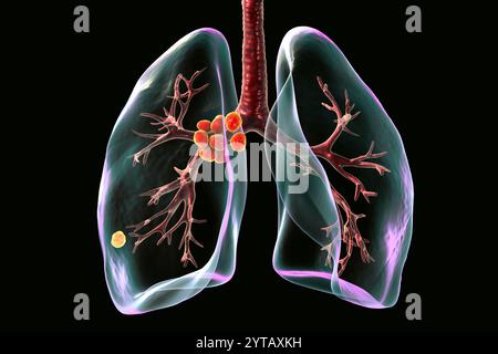 Primary lung tuberculosis. Computer illustration featuring the Ghon ...