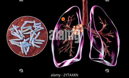 Illustration of primary lung tuberculosis with the Ranke complex ...