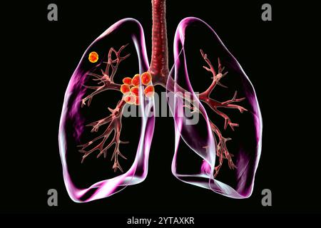 Primary lung tuberculosis. Computer illustration featuring the Ghon ...
