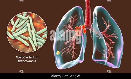 Primary lung tuberculosis. Computer illustration featuring the Ghon ...