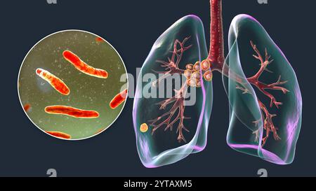 Primary lung tuberculosis with the Ranke complex. Computer illustration ...