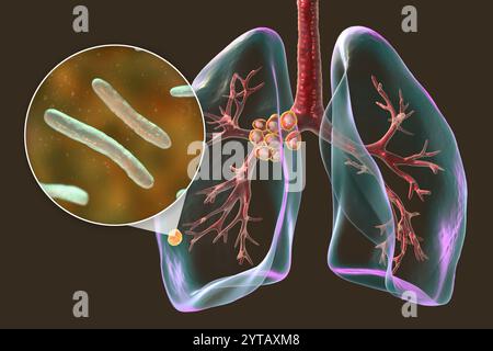 Illustration of primary lung tuberculosis with the Ranke complex ...