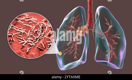 Illustration of primary lung tuberculosis with the Ranke complex ...