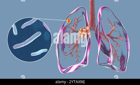 Illustration of primary lung tuberculosis with the Ranke complex ...