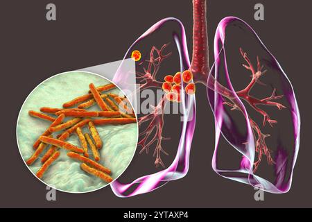 Primary lung tuberculosis. Computer illustration featuring the Ghon ...