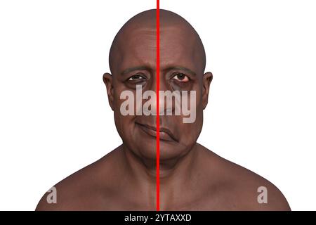 Facial palsy in a man. Computer illustration highlighting the asymmetry ...