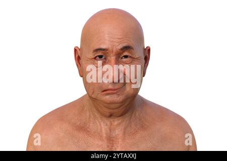Facial palsy in a man. Computer illustration highlighting the asymmetry ...