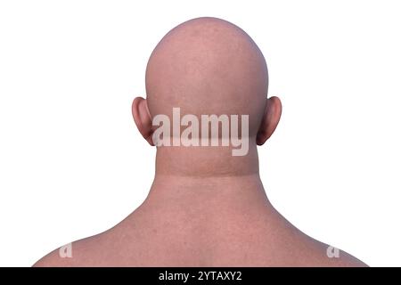 Illustration of the muscles of the neck and nape muscles. This ...