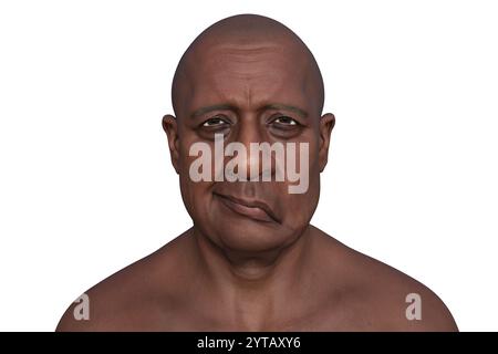 Computer illustration of a man showing left-side stroke, with drooping ...