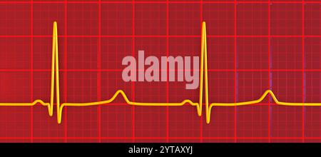 Illustration of an electrocardiogram (ECG) showing late onset T waves ...