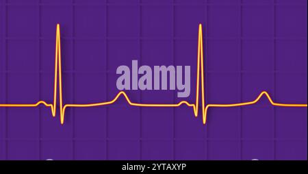 Illustration of an electrocardiogram (ECG) showing late onset T waves ...