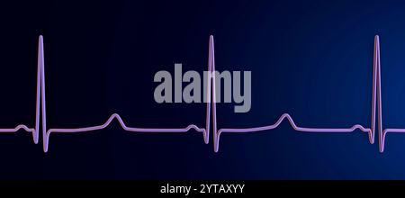 Illustration of an electrocardiogram (ECG) showing late onset T waves ...