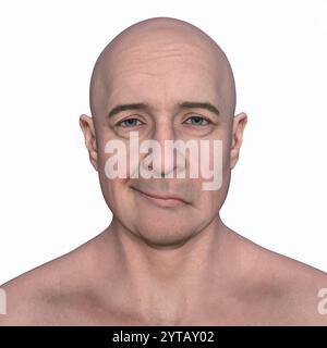 Computer illustration of a man showing left-side stroke, with drooping ...