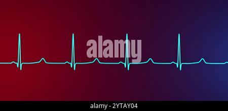 Illustration of an electrocardiogram (ECG) showing late onset T waves ...