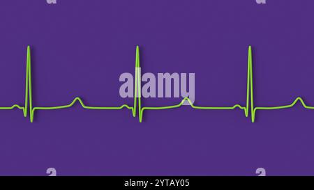 Illustration of an electrocardiogram (ECG) showing late onset T waves ...
