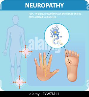 Illustration of neuropathy affecting hands and feet Stock Vector Image ...