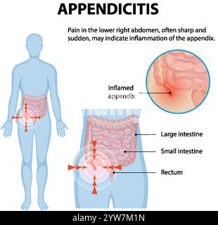 Appendicitis symptoms. Appendix disease abdominal pain infographic. Diarrhea and vomiting ...