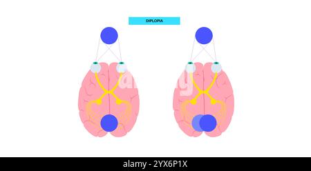 Double vision (diplopia), illustration Stock Photo - Alamy