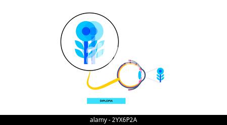 Double vision (diplopia), illustration Stock Photo - Alamy
