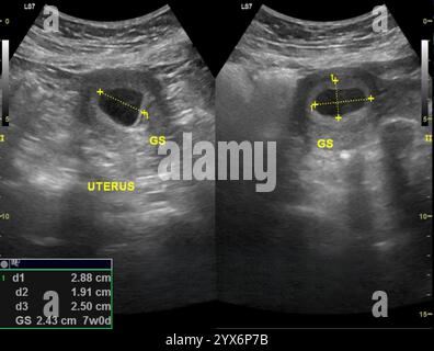 The human embryo at around 4 weeks, showing the umbilicus & blood ...