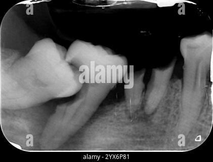 Periapical X-ray of cavities, or caries, in an upper left second ...