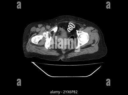 Ectopic IUD contraceptive. Computed tomography (CT) scan of an axial ...