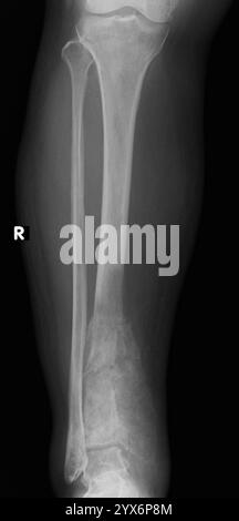 X-ray of the lower leg of a patient with an aggressive bone tumour. The ...