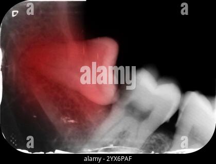dental x-ray with impacted wisdom tooth Stock Photo - Alamy