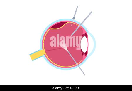 Vitrectomy surgery, illustration Stock Photo - Alamy