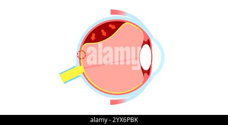 Retinal detachment, illustration Stock Photo - Alamy