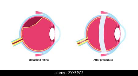 Scleral buckle procedure, illustration. This is a procedure used to ...