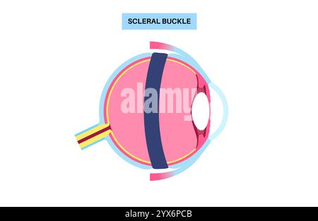 Scleral buckle procedure, illustration. This is a procedure used to ...
