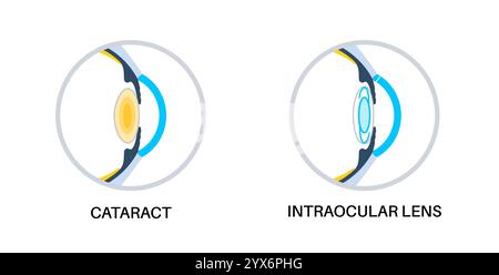 Intraocular lens implantation, illustration Stock Photo - Alamy
