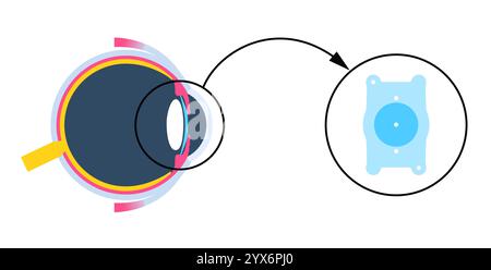 Implantable collamer lens surgery, illustration Stock Photo - Alamy