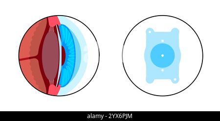 Implantable collamer lens surgery, illustration Stock Photo - Alamy
