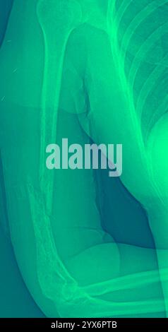 Broken upper arm bone. Coloured x-ray of the left arm of a 52-year-old ...