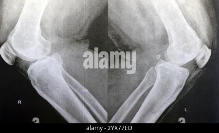 Plain x-ray of the knee showing apparent joint osteoarthritis according ...