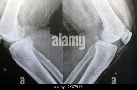 Plain x-ray of the knee showing apparent joint osteoarthritis according ...