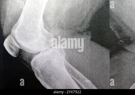 Plain x-ray of the knee showing apparent joint osteoarthritis according ...
