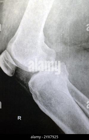Plain x-ray of the knee showing apparent joint osteoarthritis according ...