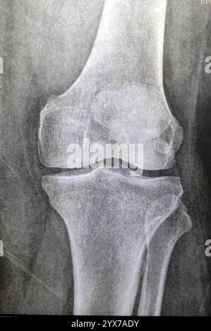 Plain x-ray of the knee showing apparent joint osteoarthritis according ...