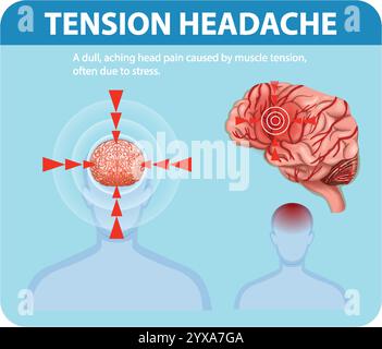Illustration of tension headache and brain anatomy Stock Vector Image ...