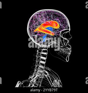 Computer illustration of enlarged lateral ventricles (hydrocephalus) of ...