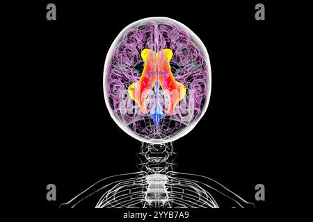 Enlarged lateral ventricles of the brain, illustration Stock Photo - Alamy