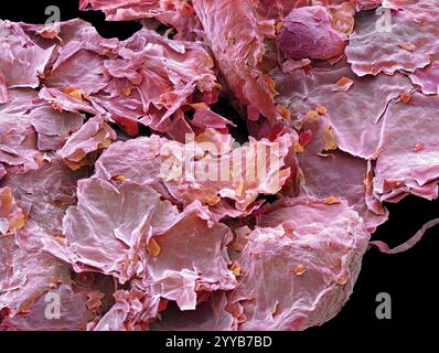 Psoriasis. Coloured scanning electron micrograph (SEM) of skin cells ...
