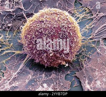 Cervical cancer cell. Coloured scanning electron micrograph (SEM) of a ...