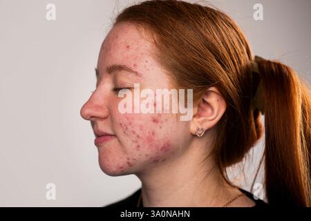 Many Pimples Girl With Bad Skin Hormonal Acne Puberty Skin Acne